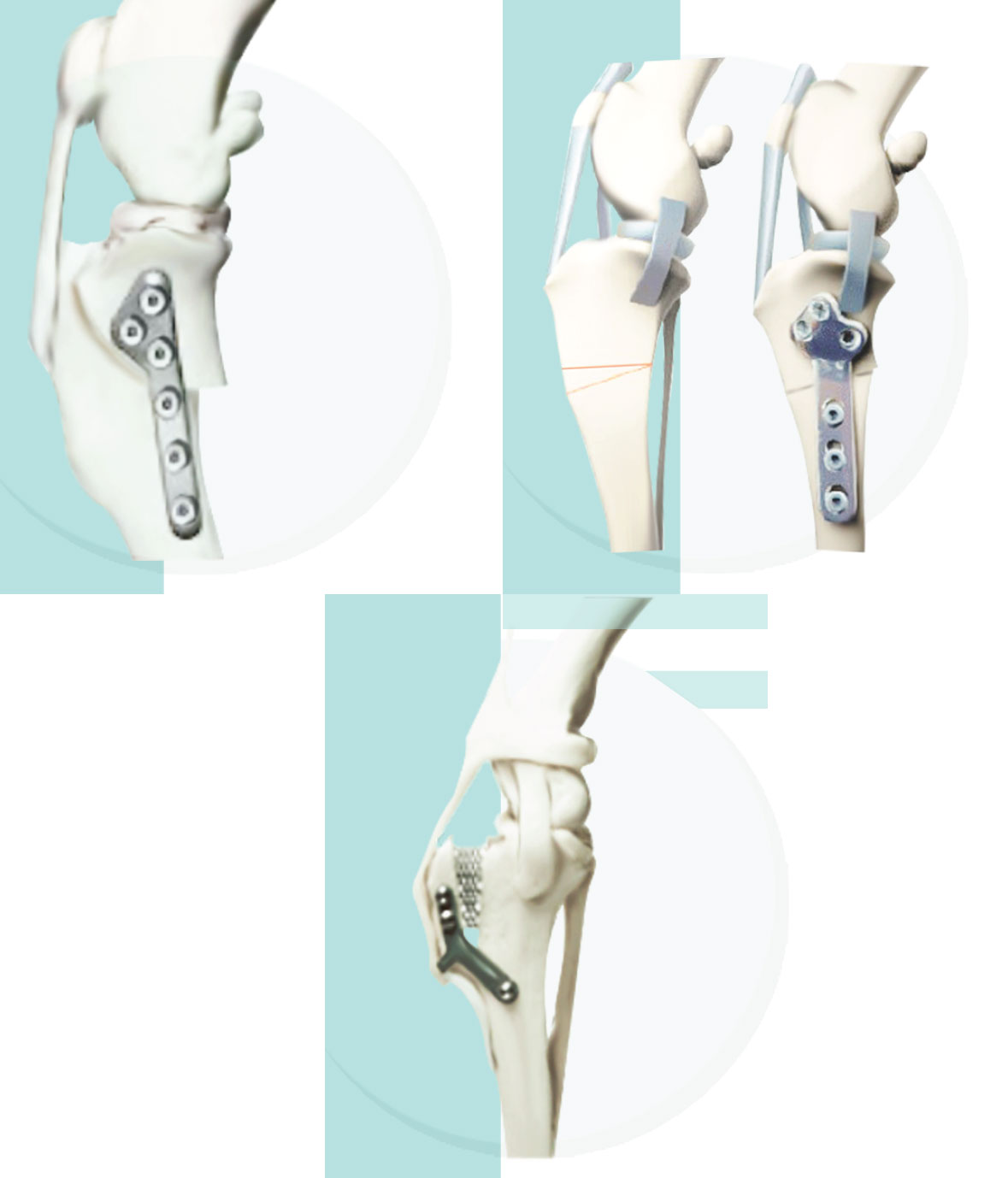 Curso Especializado en Cirugía de Rodilla Nivel Máster (TTA-CTWO-TPLO ...